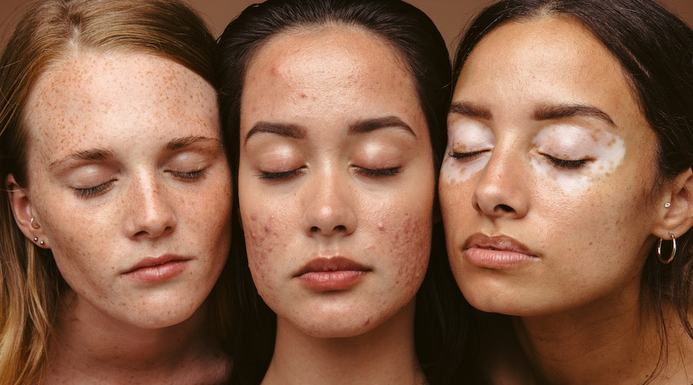 10 Best Essential Oils For Oily And Acne Skin – Oils4life